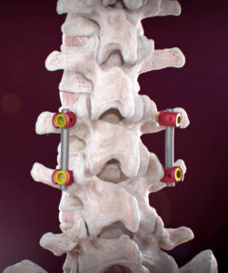 Spinal Alignment Tool: Self-Managing and Surgical Spine Options