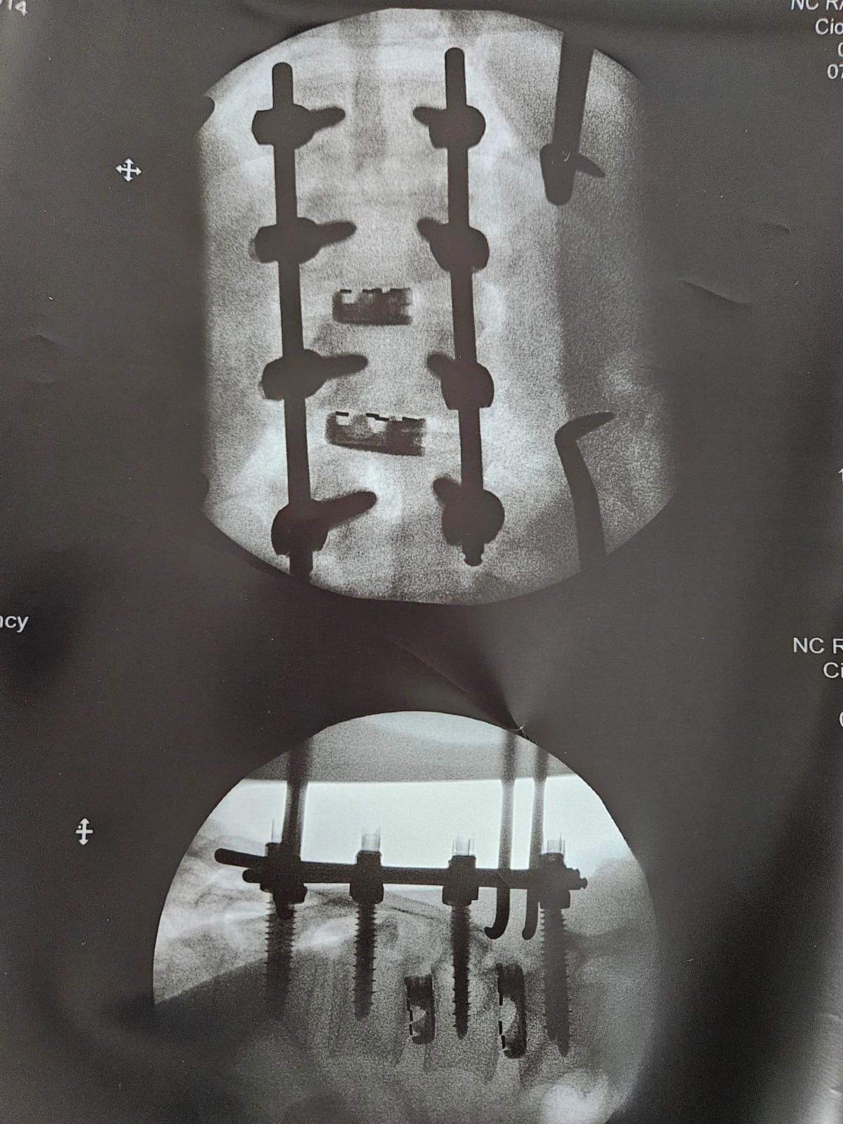 RJB Surgical Angle Measurement tool: Impact in Africa | Ruthless Spine